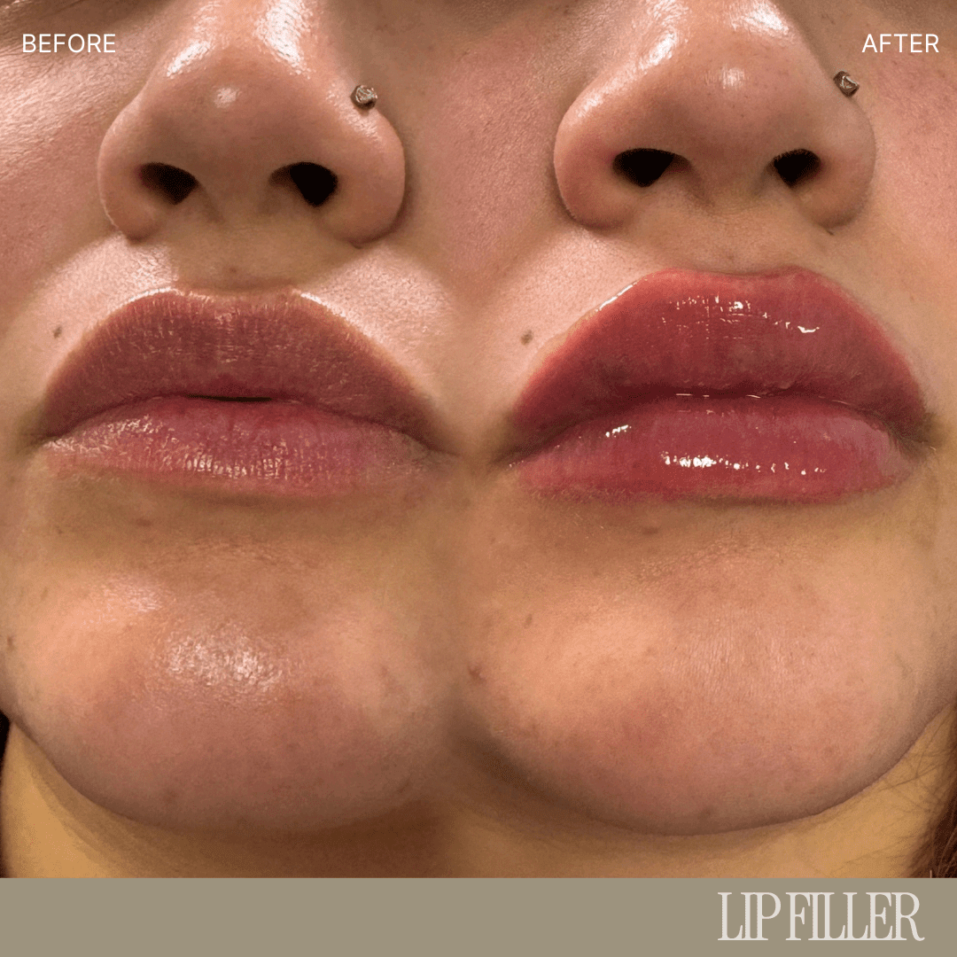 Before & After Med Spa Photos | Cactus Rose Aesthetics