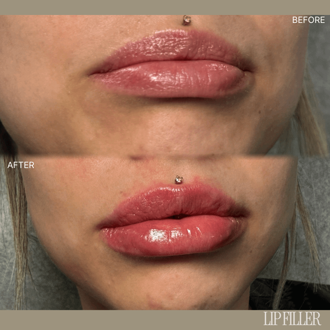 Before & After Med Spa Photos | Cactus Rose Aesthetics